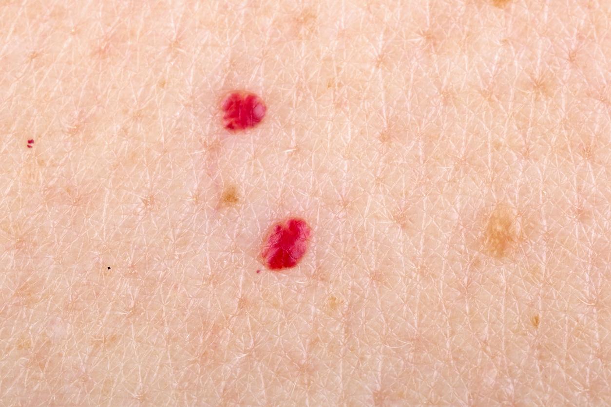 Qu Son Estos Puntos Rojos En La Piel Y Por Qu Aparecen Qu Son Estos Puntos Rojos En La Piel Y Por Qu Aparecen